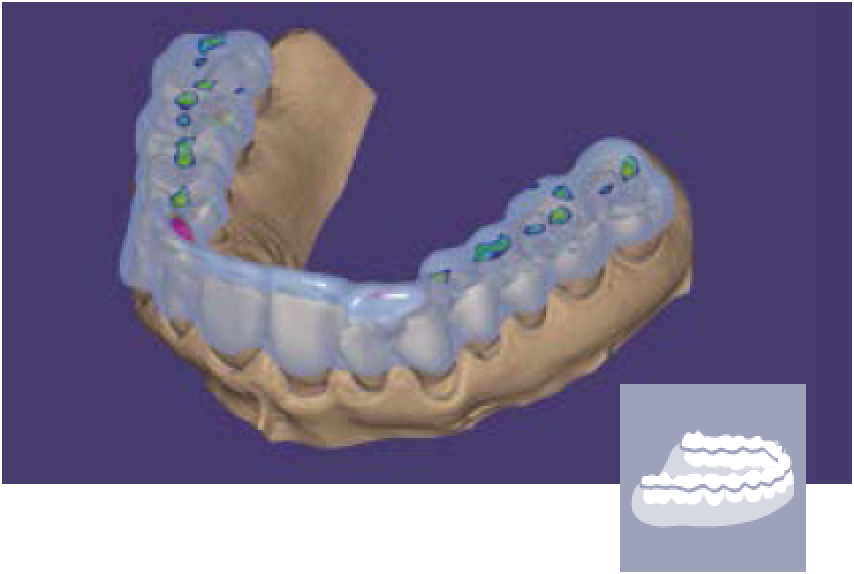 exocad -Bite Splint Module – Unique Dental Supply Inc.
