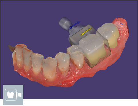exocad - InCAD Nesting Add-on Module – Unique Dental Supply Inc.