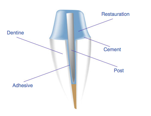 Cylindrical - Fiber Posts – Unique Dental Supply Inc.