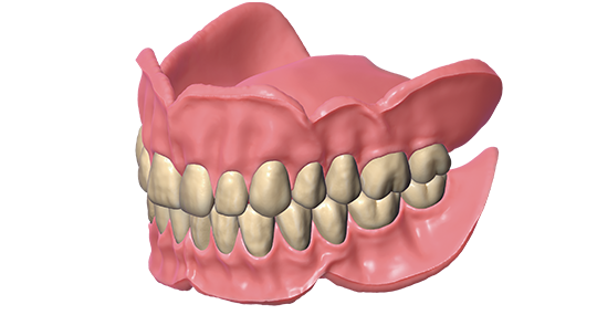 exocad overdenture